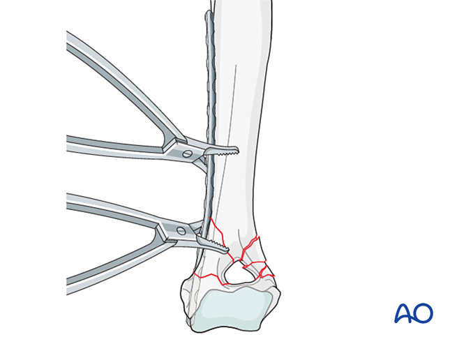 Bridging plate and pin for Complex extra-articular fractures of the dog ...