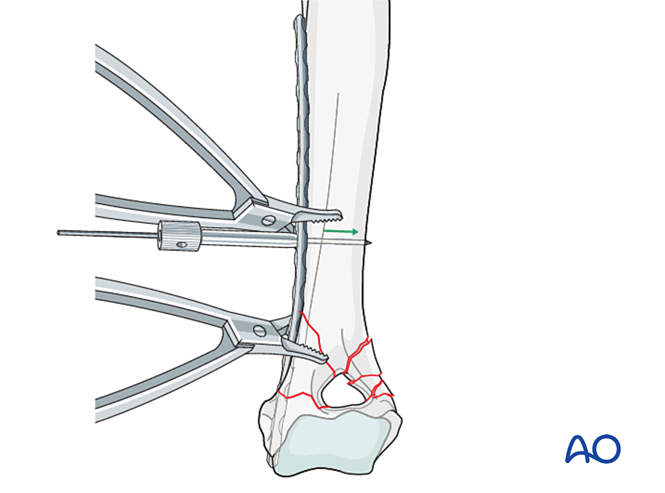 Bridging plate and pin for Complex extra-articular fractures of the dog ...