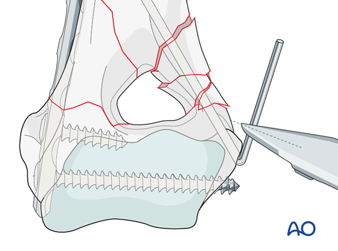 Bridging plate and pin for Complex extra-articular fractures of the dog ...