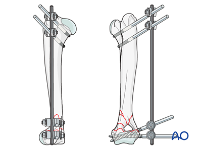 External skeletal fixator for Complex extra-articular fractures of the ...