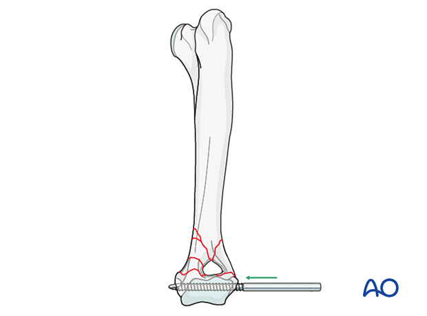 External skeletal fixator for Complex extra-articular fractures of the ...