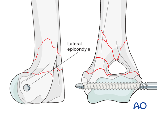 External skeletal fixator for Complex extra-articular fractures of the ...