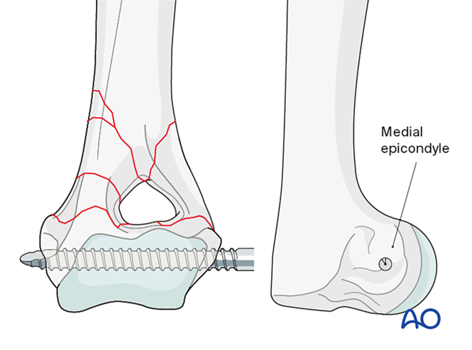 External skeletal fixator for Complex extra-articular fractures of the ...
