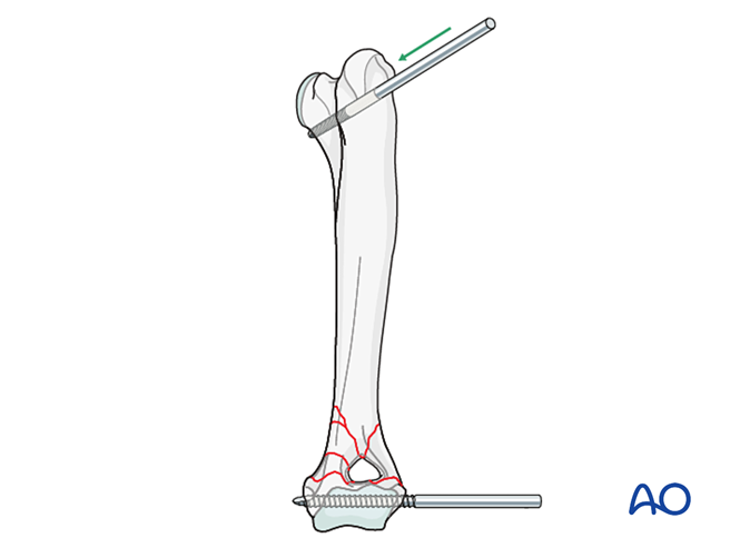 External skeletal fixator for Complex extra-articular fractures of the ...