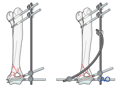 External skeletal fixator for Complex extra-articular fractures of the ...
