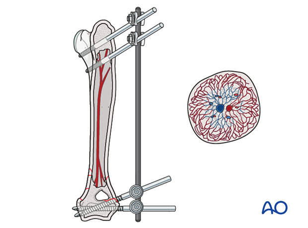General considerations on external skeletal fixators