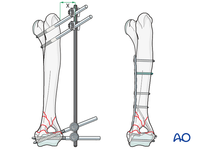 General considerations on external skeletal fixators
