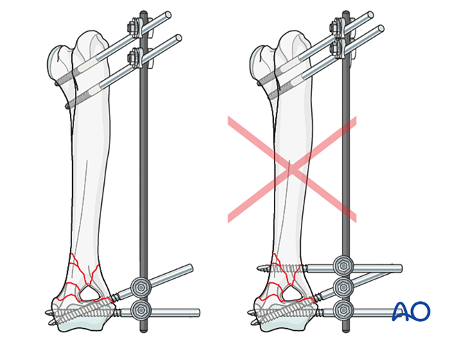 General considerations on external skeletal fixators