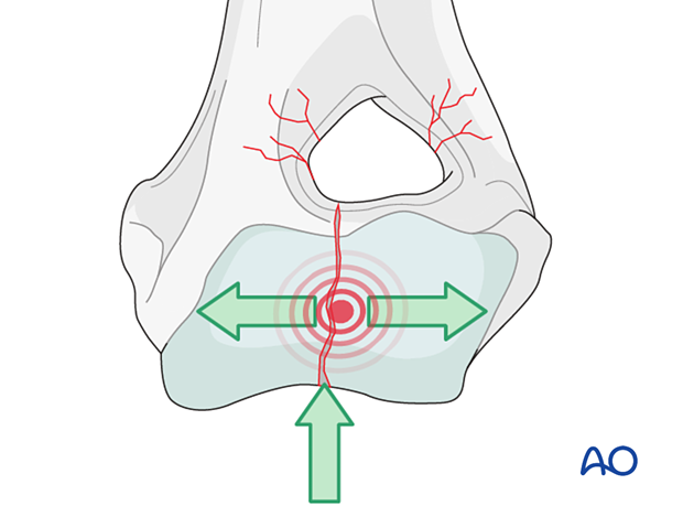 Incomplete ossification of the humeral condyle
