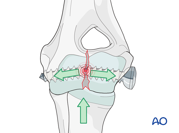 Incomplete ossification of the humeral condyle