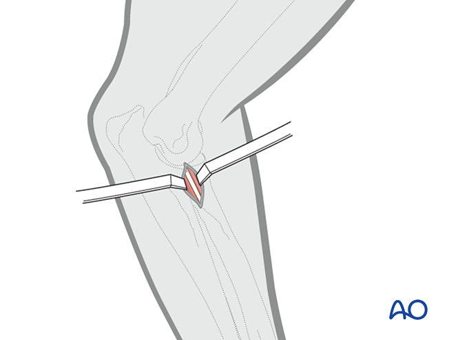 All approaches to the dog radial and ulnar shaft