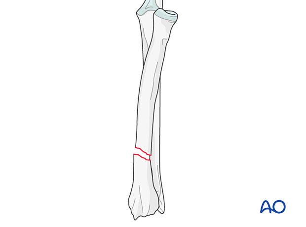 Incomplete fracture of the diaphyseal radius or fracture of one bone only