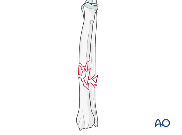 Complex fracture of the diaphyseal radius with simple or wedge ulnar ...