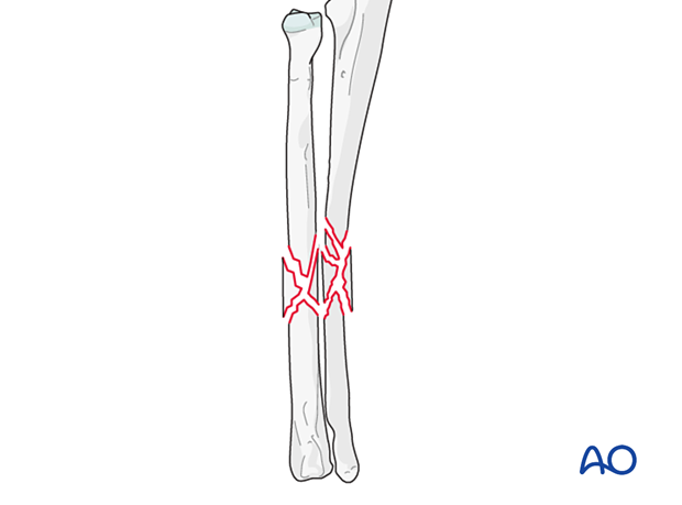 Complex fracture of the diaphyseal radius with complex ulnar fracture