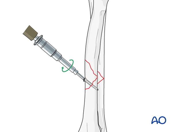 Lag screws and neutralization plate for Wedge fracture of the distal ...