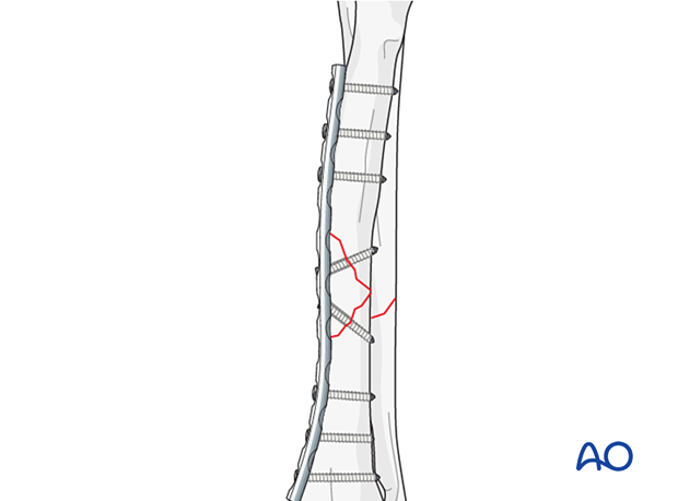 Lag screws and neutralization plate for Wedge fracture of the ...