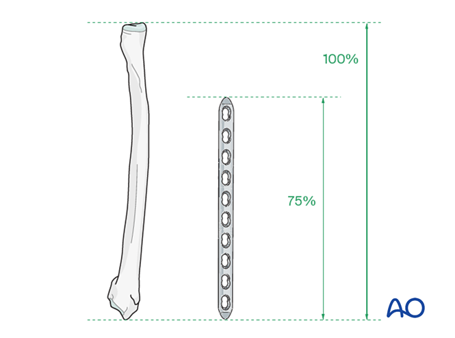 Bridging plate for Wedge fracture of the distal zone of the diaphyseal ...