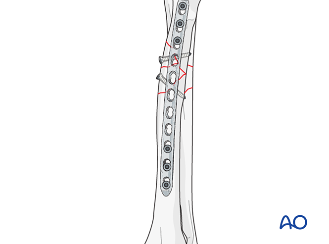 Lag screws and neutralization plate for Wedge fracture of the proximal ...