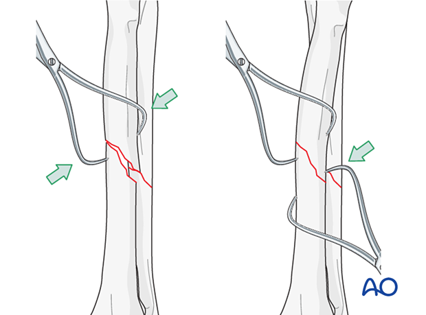 Lag screws and neutralization plate for Simple fracture of the distal ...