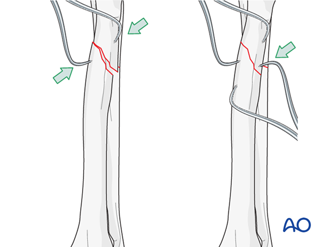 Lag screws and neutralization plate for Simple fracture of the proximal ...
