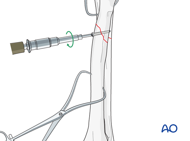 Lag screws and neutralization plate for Simple fracture of the proximal ...