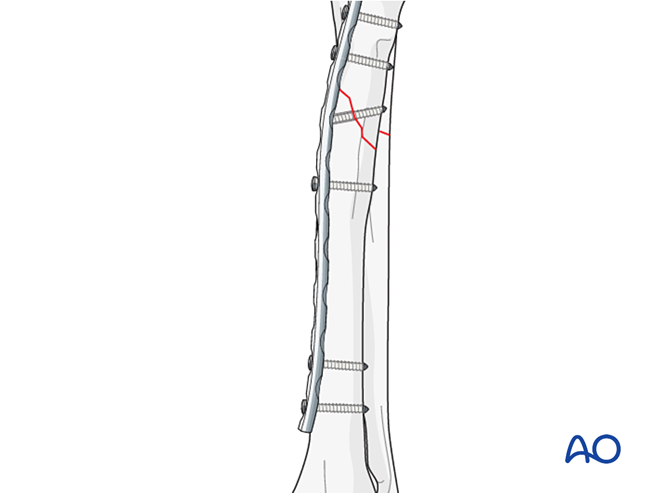 Lag screws and neutralization plate for Simple fracture of the proximal ...