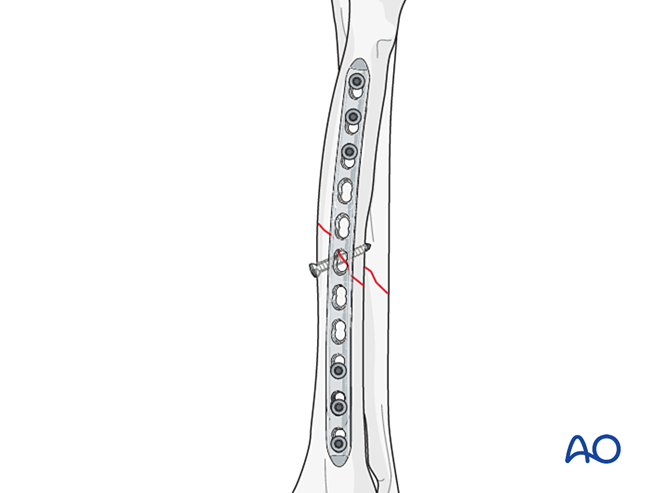 Lag screws and neutralization plate for Simple fracture of the distal ...