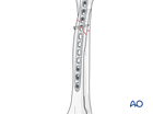 Treatment of Simple fracture of the proximal zone of the diaphyseal radius