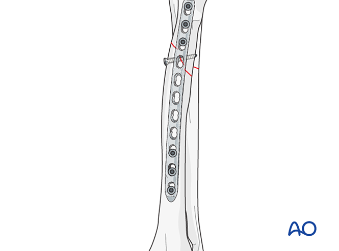 Lag screws and neutralization plate for Simple fracture of the proximal ...
