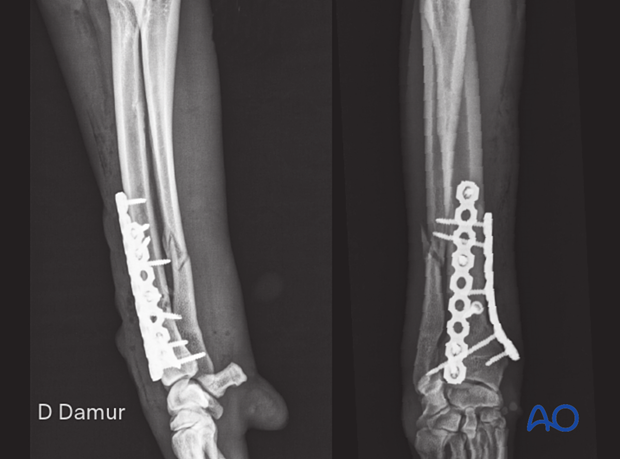 Lag screws and neutralization plate for Simple fracture of the distal ...