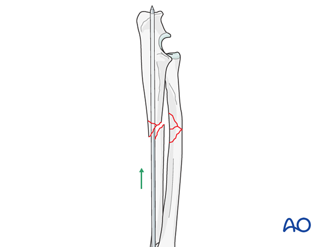 Lag screw and neutralization plate on radius with intramedullary pin or ...