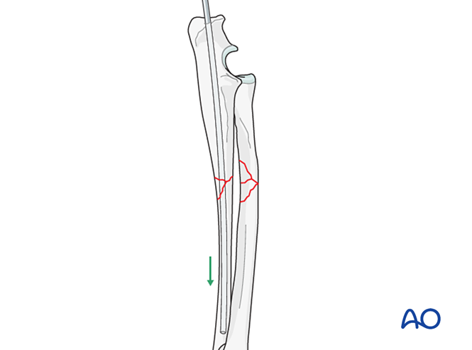 Lag screw and neutralization plate on radius with intramedullary pin or ...