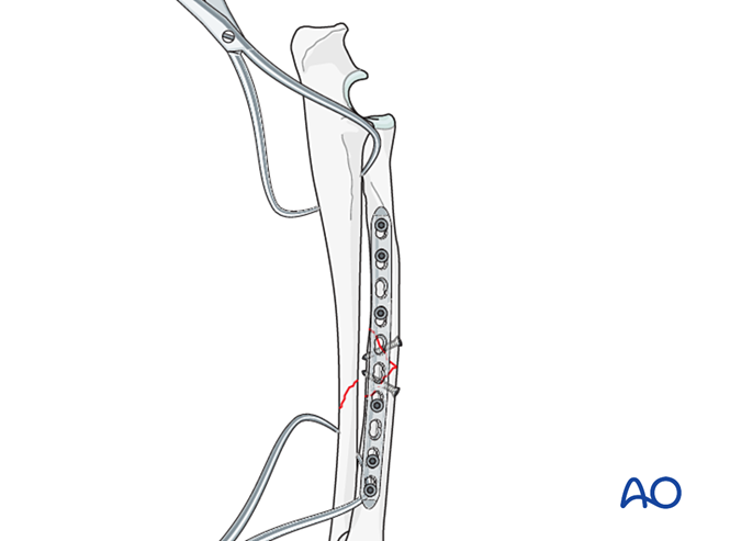 Lag screw and neutralization plate on radius with intramedullary pin or ...