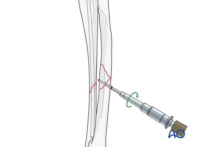 Lag screw and neutralization plate on radius with intramedullary pin or ...