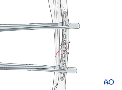Lag screw and neutralization plate on radius with intramedullary pin or ...