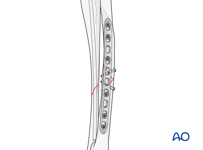 Lag screw and neutralization plate on radius with intramedullary pin or ...