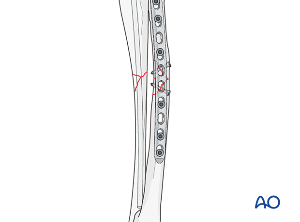 Lag screw and neutralization plate on radius with intramedullary pin or ...