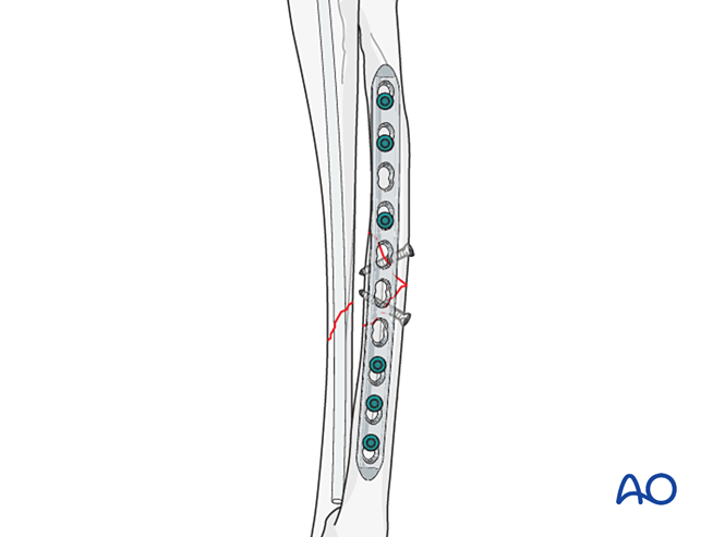 Lag screw and neutralization plate on radius with intramedullary pin or ...