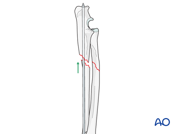 Lag screw and neutralization plate on radius with intramedullary pin or ...