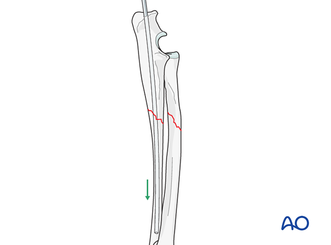 Lag screw and neutralization plate on radius with intramedullary pin or ...