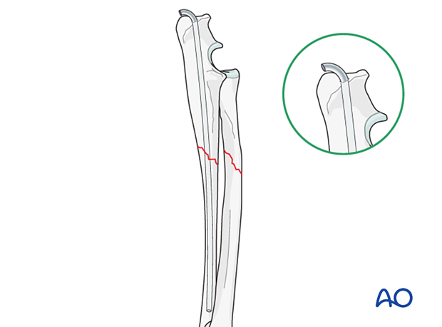 Lag screw and neutralization plate on radius with intramedullary pin or ...