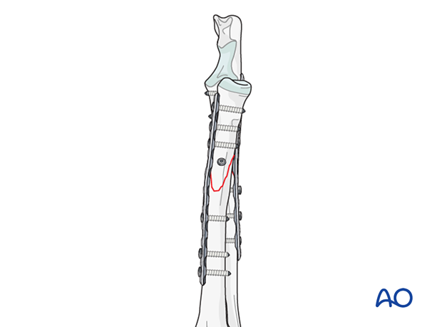Lag screw and neutralization plate on radius with intramedullary pin or ...