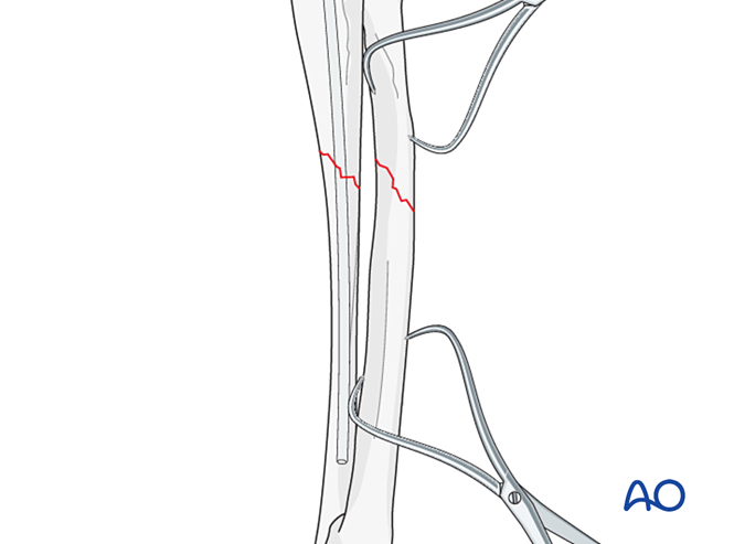 Lag screw and neutralization plate on radius with intramedullary pin or ...