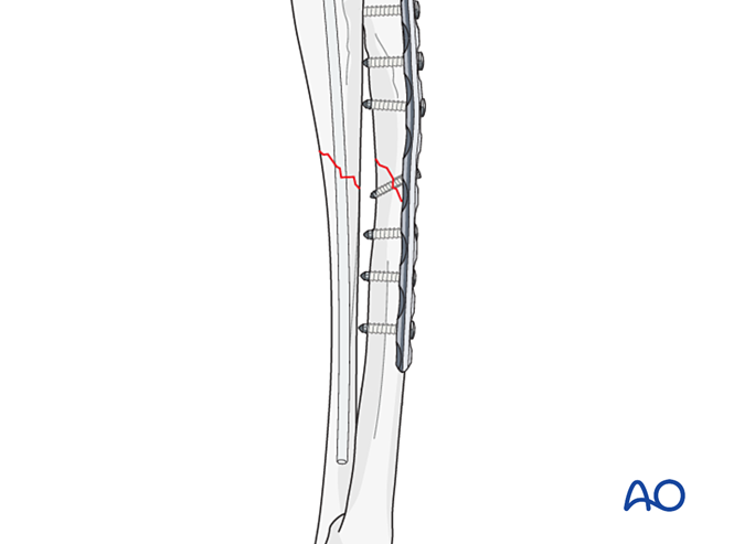 Lag screw and neutralization plate on radius with intramedullary pin or ...