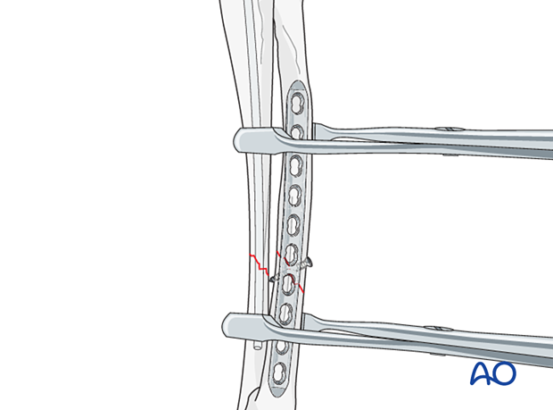 Lag screw and neutralization plate on radius with intramedullary pin or ...