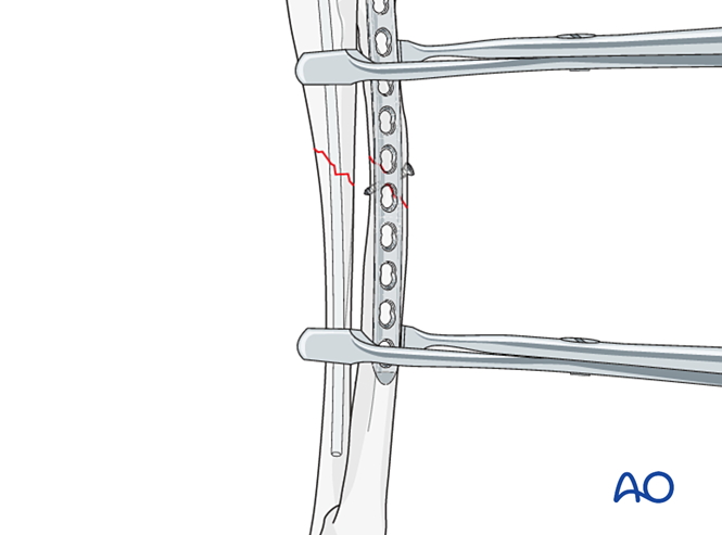 Lag screw and neutralization plate on radius with intramedullary pin or ...