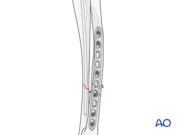 Lag screw and neutralization plate on radius with intramedullary pin or ...