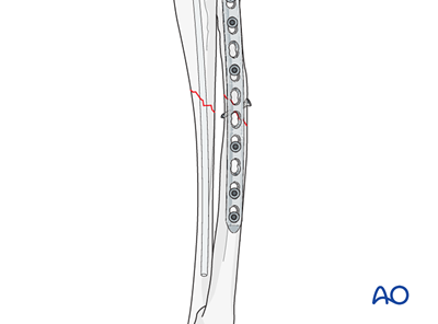 Lag screw and neutralization plate on radius with intramedullary pin or ...