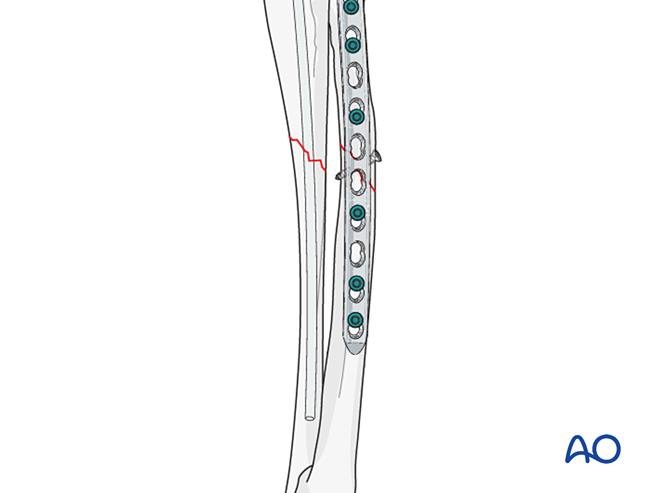 Lag screw and neutralization plate on radius with intramedullary pin or ...