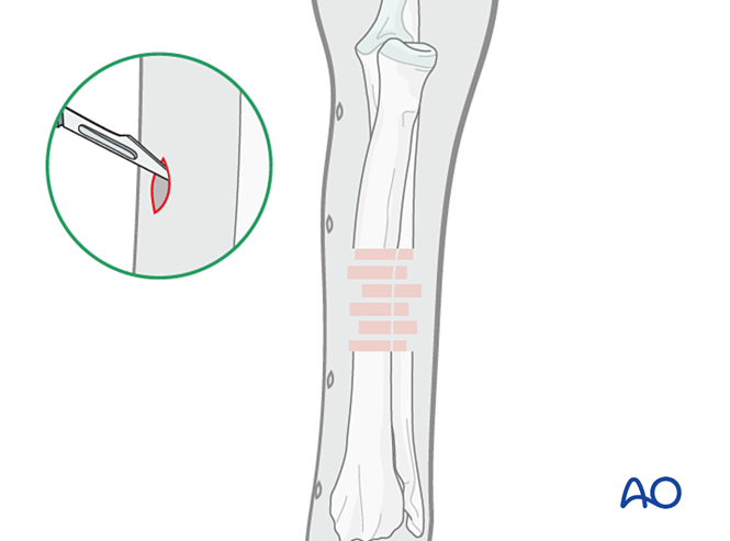 Linear external skeletal fixator for Complex fracture of the diaphyseal ...